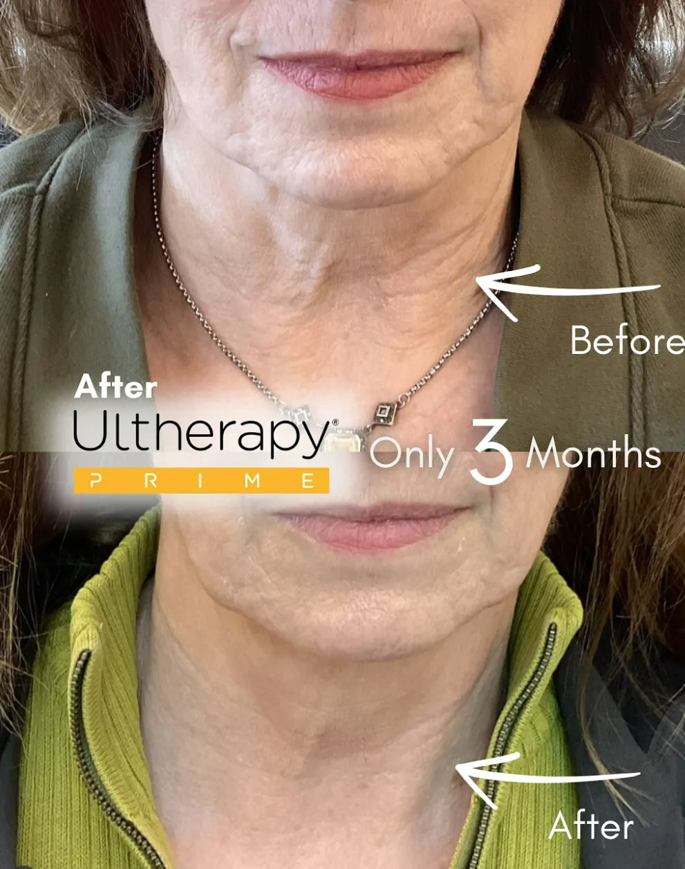 Ultherapy Prime King of Prussia & Bryn Mawr | Lux Skin & Lasers Margate, NJ